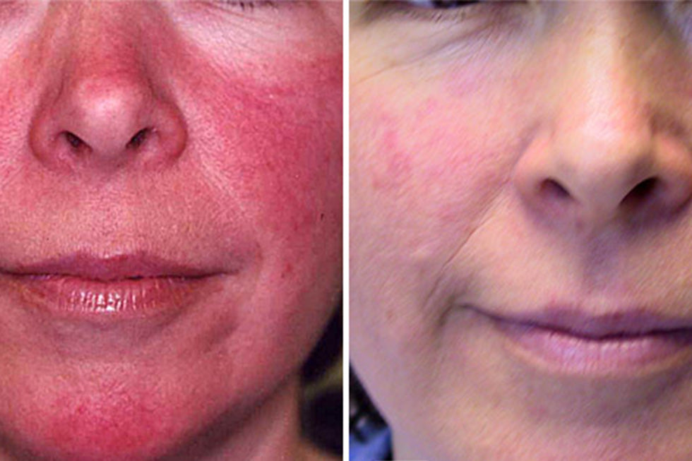 Rosacea Awareness Month | Face the Future