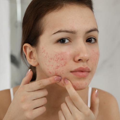 Fungal vs Hormonal Acne: How to Tell the Difference | Face the Future