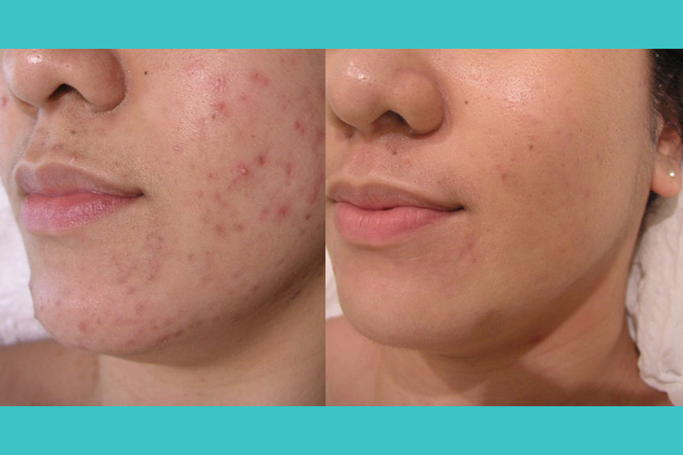 Acne Series: Danne Montague-King | Face the Future